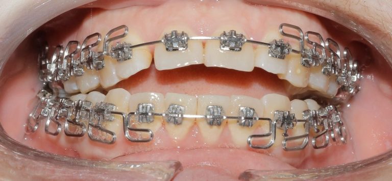 Chỉnh Nha Thay Phẫu Thuật Hàm - Kỹ Thuật Meaw - Geaw | Việt Hùng Group