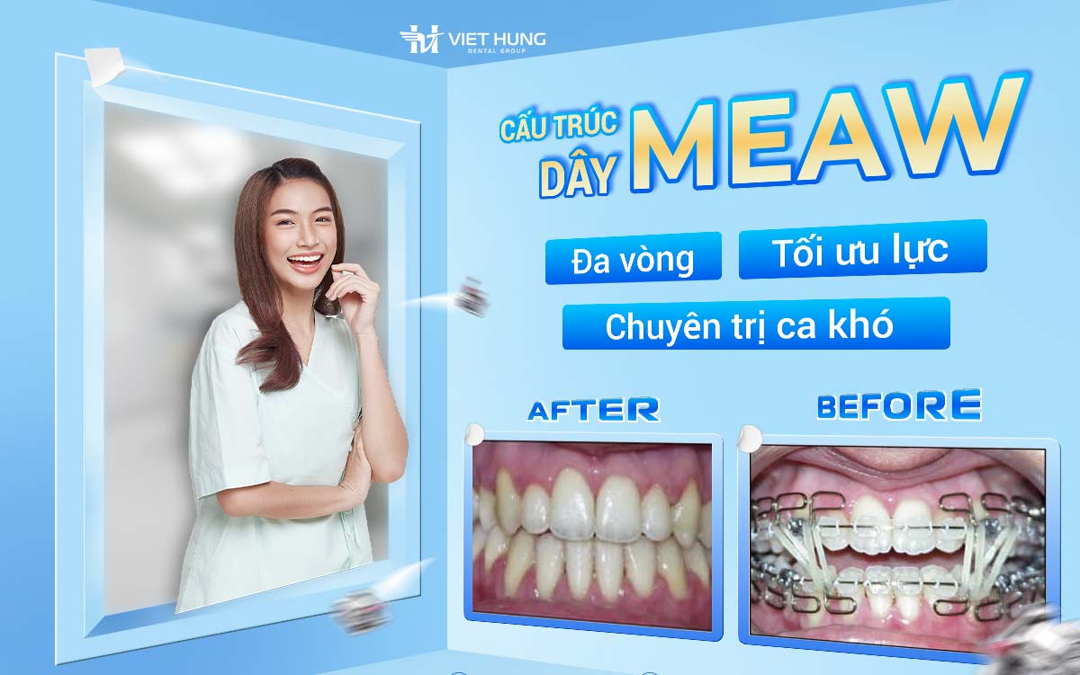 Kỹ Thuật Meaw Trong Điều Trị Chỉnh Nha Nâng Cao | Việt Hùng Group